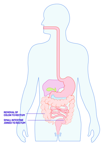 Surgery for Ulcerative Colitis