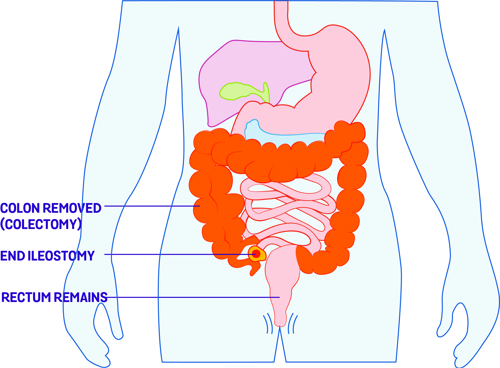 Surgery for Ulcerative Colitis