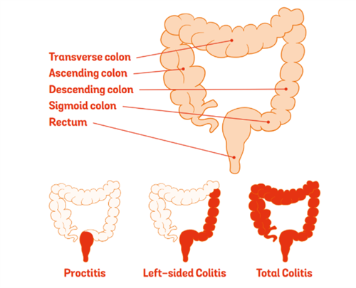 Surgery for Ulcerative Colitis